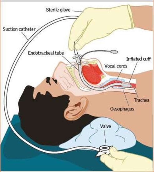 A staff nurse is observing a newly licensed nurse suction | Nursing Exam